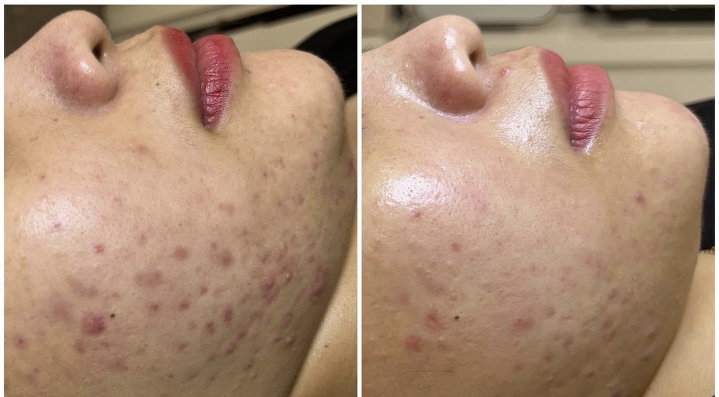 Algae peeling – Skin regeneration, dark spot reduction, effective acne ...